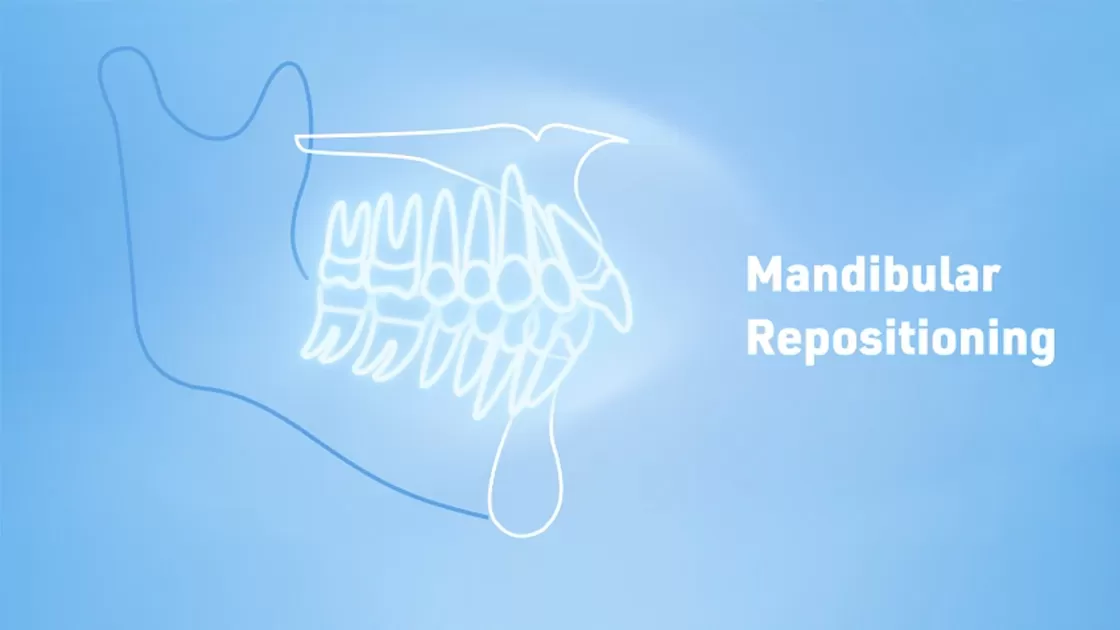 Coût et technologie du dispositif de repositionnement mandibulaire Smartee, Apnée du sommeil MRD